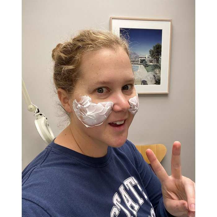 Amy Schumer Dissolves Filler, Shares Thoughts on Plastic Surgery | Us ...