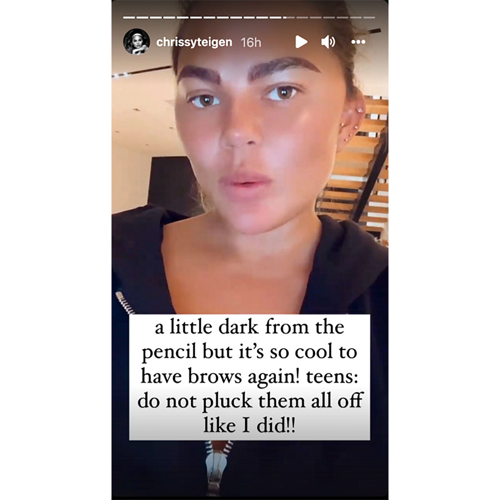 Chrissy Teigen Shares Results of 'Eyebrow Transplant Surgery': Pic | Us ...