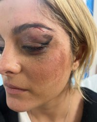 Bebe Rexha Shares Black Eye Pics After Fan Throws Phone at Her | Us Weekly