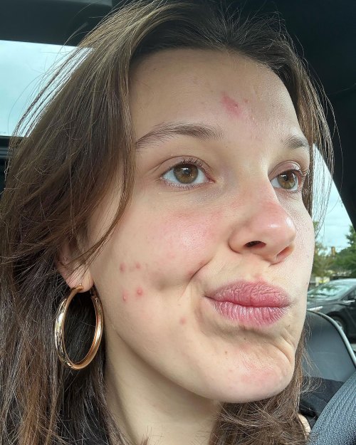 Millie Bobby Brown Posts Makeup-Free Selfie of Her Acne | Us Weekly