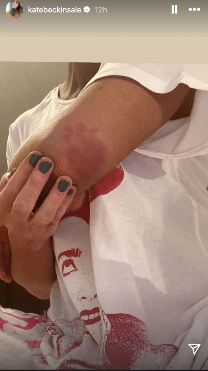 Kate Beckinsale Shares Photos of Stunt Work Injuries | Us Weekly