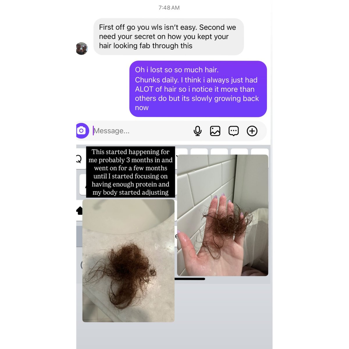 Remi Bader Shares Pics of Her Hair Loss Following Weight Loss Surgery ...