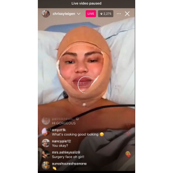 Chrissy Teigen Explains Mystery Bandaged Face Procedure | Us Weekly