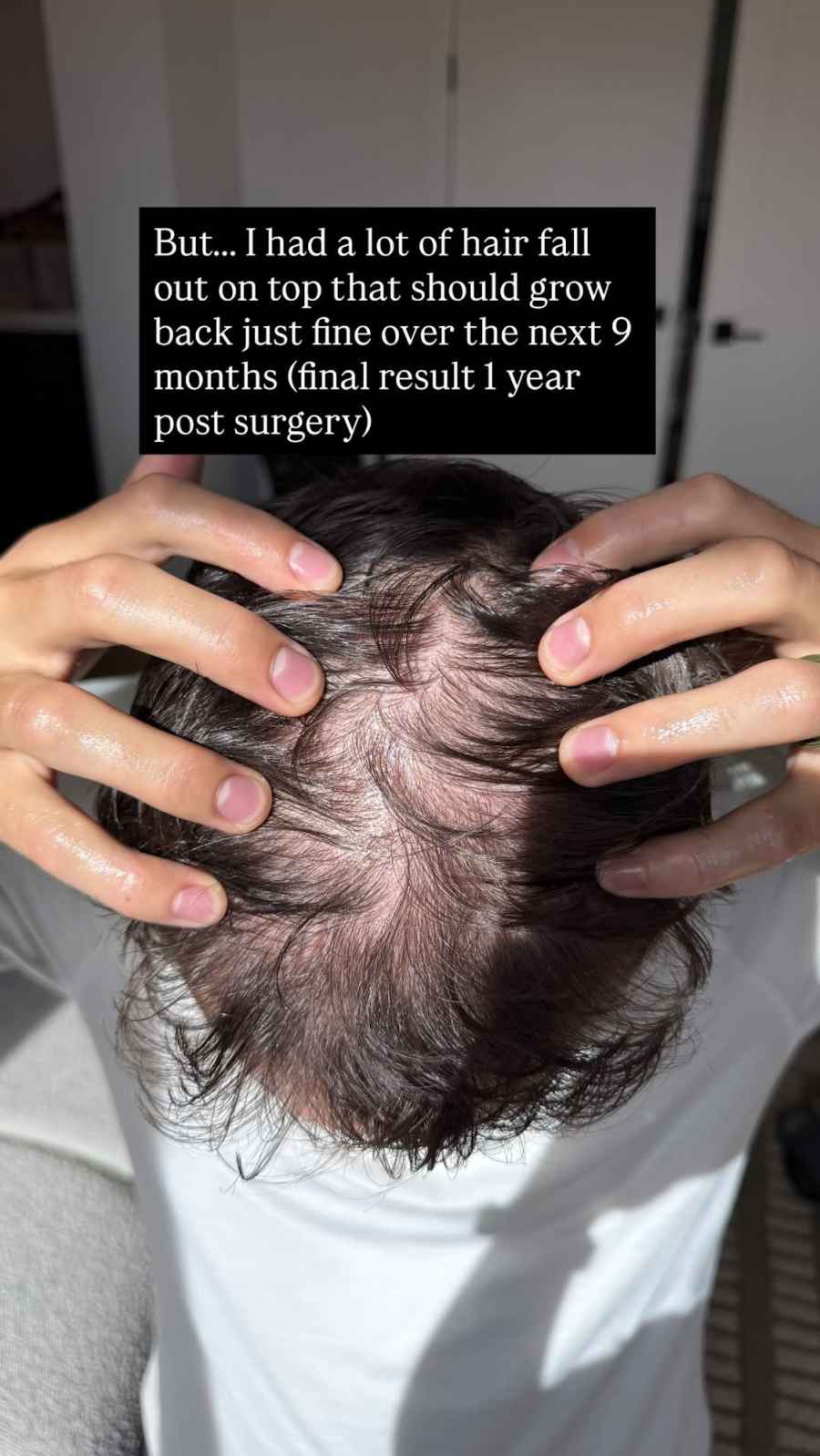 TikTok’s Matt Howard Shares Update After Receiving Hair Transplant | Us ...