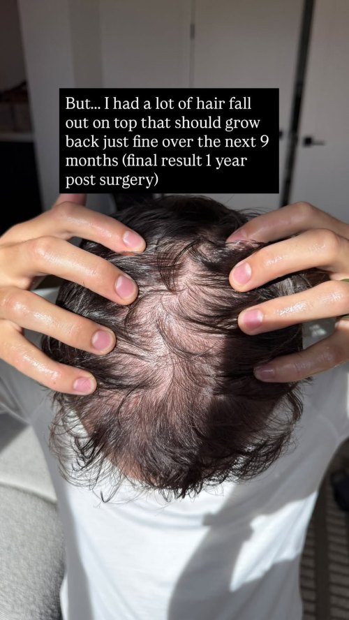 TikTok’s Matt Howard Shares Update After Receiving Hair Transplant | Us ...