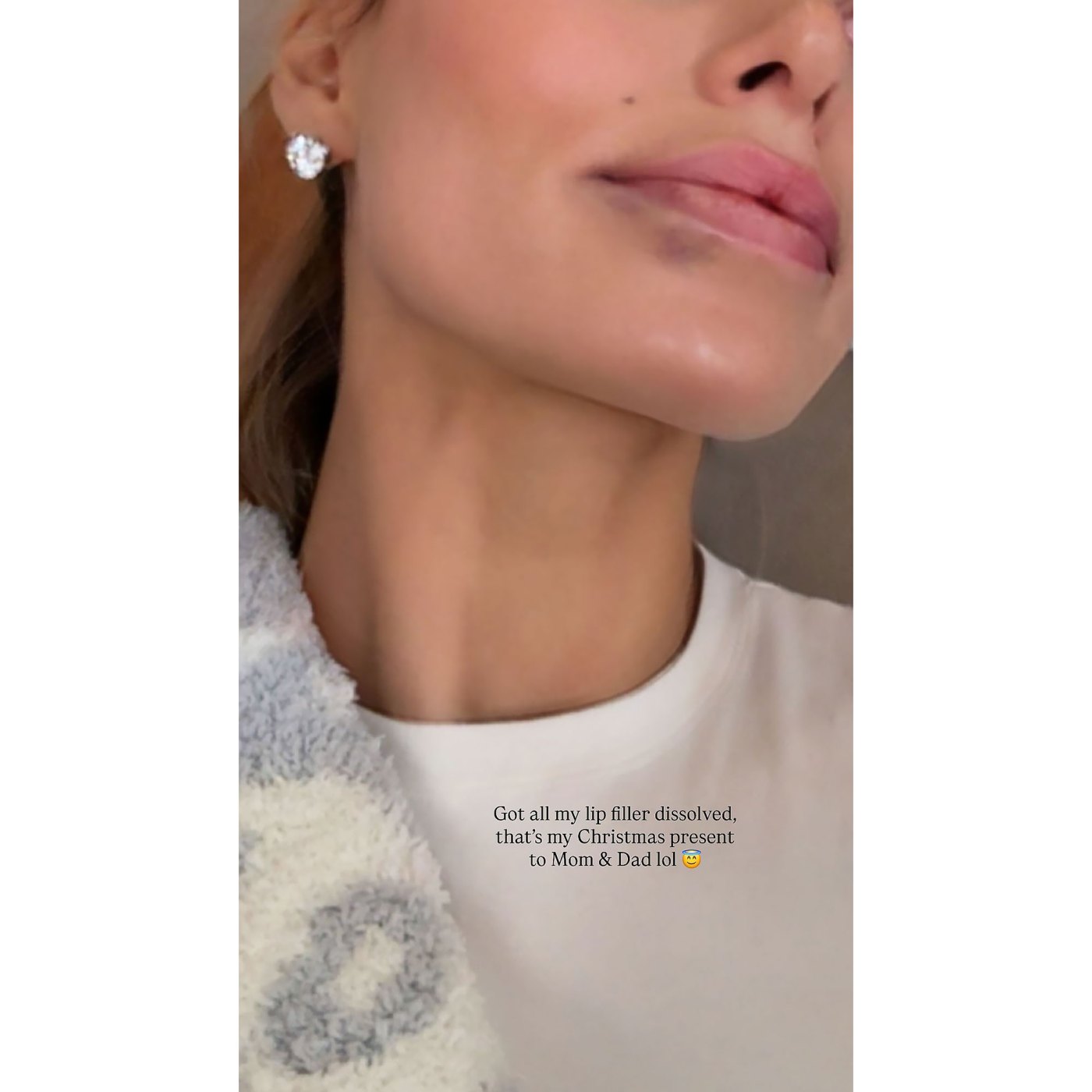Brooks Nader Gets Lip Filler Dissolved as Christmas Gift to Her Parents ...