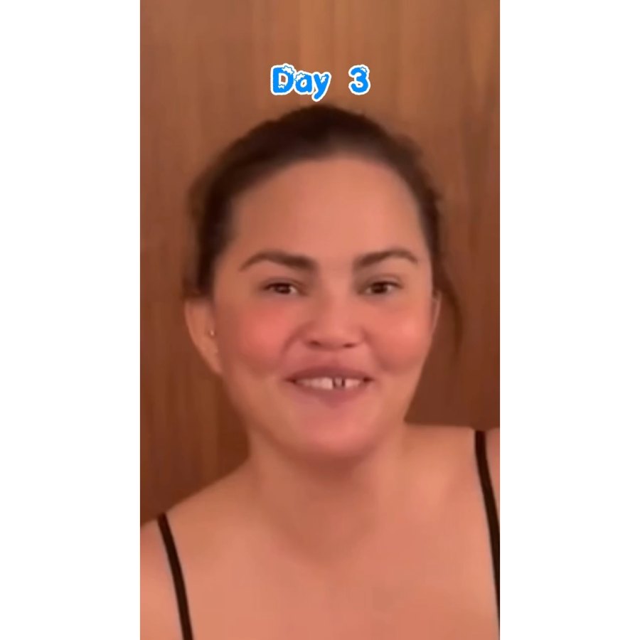 Chrissy Teigen Knocks Out Her Own Front Tooth in Candy Cane Mishap | Us ...