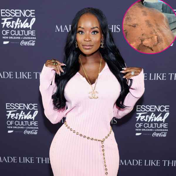 RHOA’s Shamea Morton Sues Doctor Over Chemical Peel Gone Wrong (Excl ...