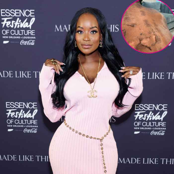 RHOA’s Shamea Morton Sues Doctor Over Chemical Peel Gone Wrong (Excl ...