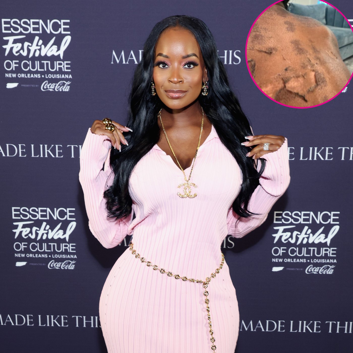 RHOA’s Shamea Morton Sues Doctor Over Chemical Peel Gone Wrong (Excl ...