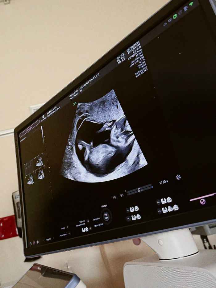 Pregnant Influencer Says Doctors Had to Stop Her Heart for 80 Minutes ...