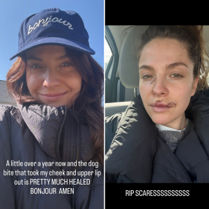 Good Doctor's Paige Spara Gives Update on Dog Attack Injury | Us Weekly