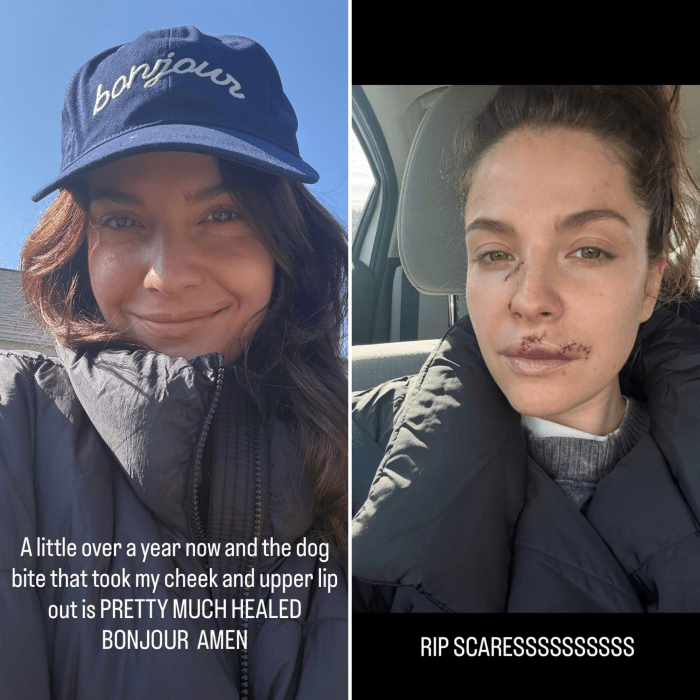 Good Doctor's Paige Spara Gives Update on Dog Attack Injury | Us Weekly